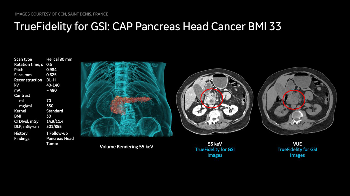 GE HealthCare | TrueFidelity for GSI Images