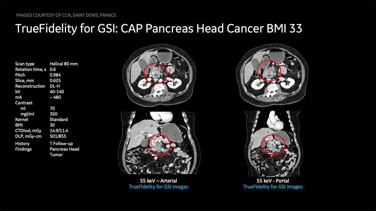 GE HealthCare | TrueFidelity for GSI Images