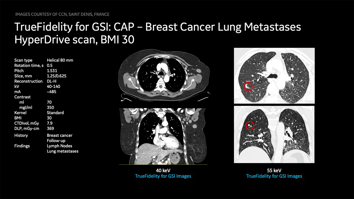GE HealthCare | TrueFidelity for GSI Images