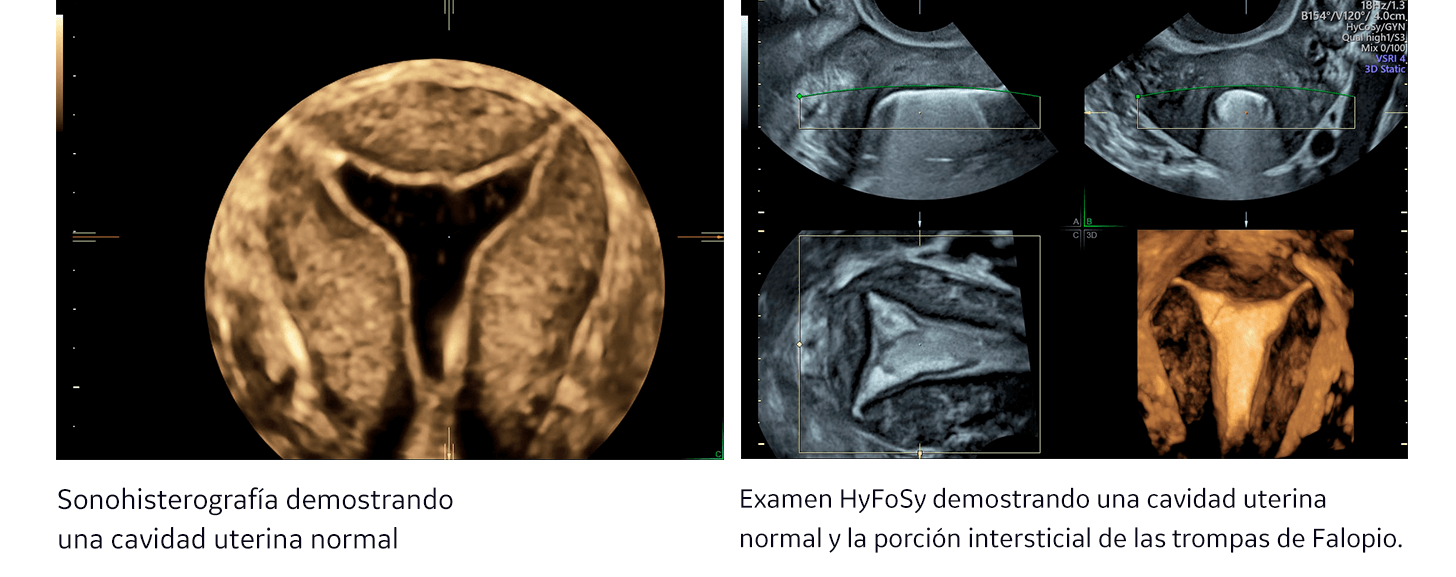 Voluson - SI LAS TROMPAS OBSTRUIDAS ESTÁN IMPIDIENDO EL EMBARAZO