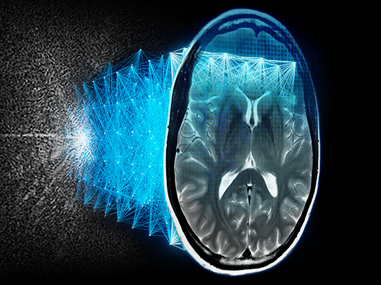 AIR Recon DL - KI-Revolution in der MRT