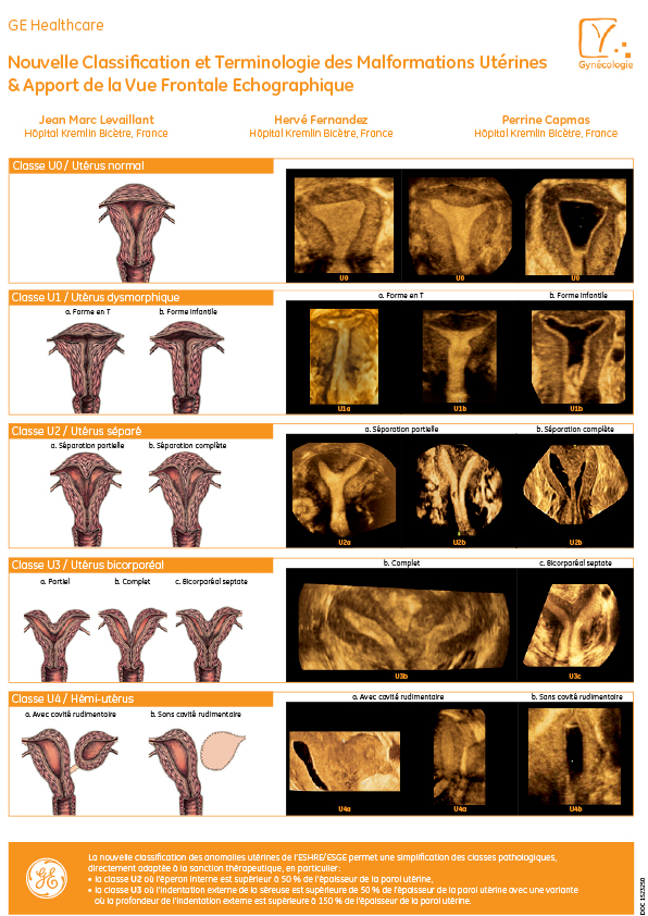 Classification des malformations utérines