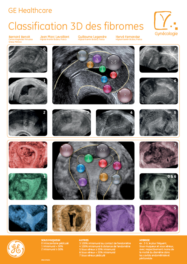 Classification 3D des fibromes