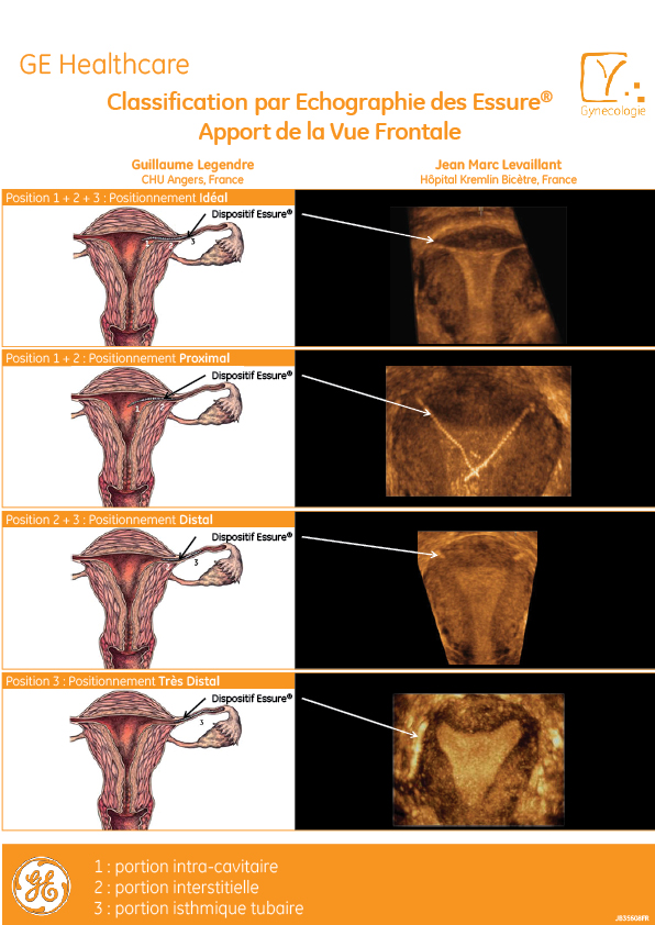Classification des Essure