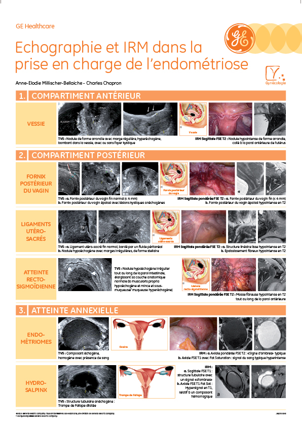 Prise en charge de l’endométriose